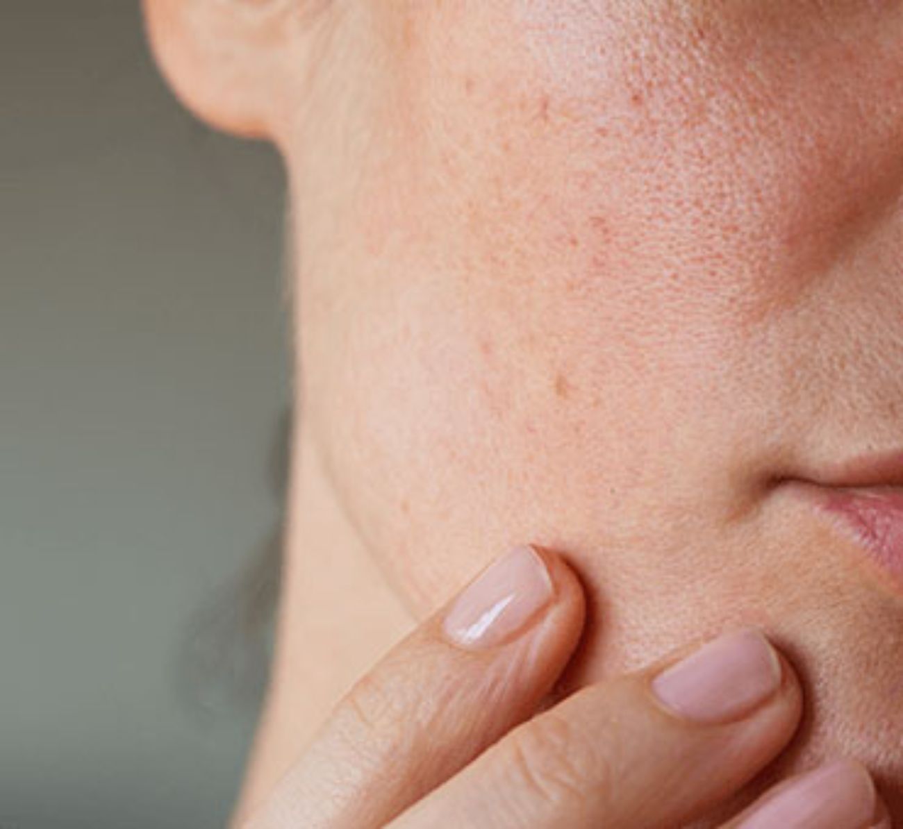 Dermatite Atopica | Dermatopia