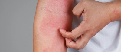 Scratched Out | Dermatopia