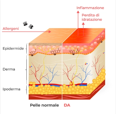 Creme Emollienti Dermatite Atopica | Dermatopia