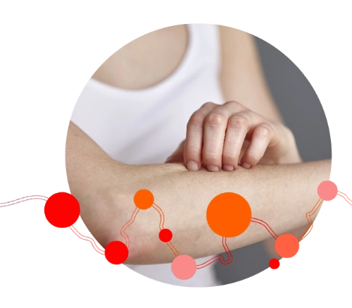 Prurigo Nodularis: cos'è e quali sono i sintomi| Dermatopia